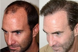Is Hair Transplant Permanent? - Glamorous Clinic