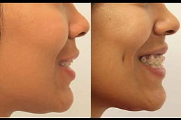 Dimple Creation in Islamabad, Rawalpindi & Pakistan | Dimpleplasty Cost