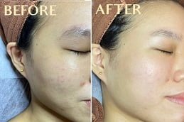 How to Reduce Pores from Face in Islamabad & Pakistan | Price & Cost