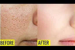 How to Reduce Pores from Face in Islamabad & Pakistan | Price & Cost