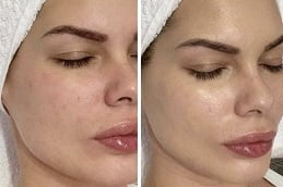 Cinderella Drip Injection in Islamabad & Pakistan | Price & Cost
