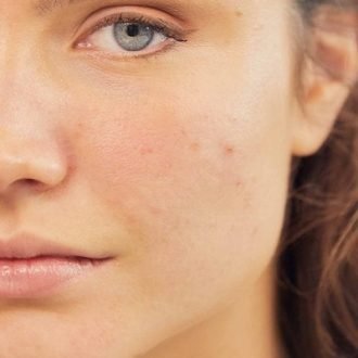 Large Pores Treatment in Islamabad, Rawalpindi & Pakistan | Open Pores