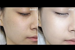 Cinderella Drip Injection in Islamabad & Pakistan | Price & Cost