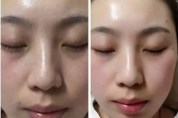 Cinderella Drip Injection in Islamabad & Pakistan | Price & Cost