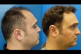 Hair Transplant Success Stories: Real-Life Transformations Islamabad