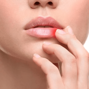 Cold Sores Treatment in Islamabad Pakistan | Glamorous Clinic