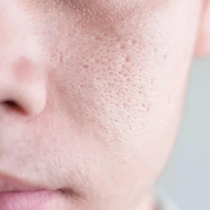 How to Reduce Pores from Face in Islamabad & Pakistan | Price & Cost