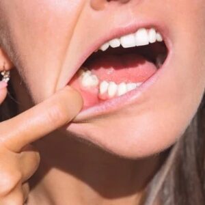 Tooth Removal in Islamabad, Rawalpindi & Pakistan | Glamorous Clinic